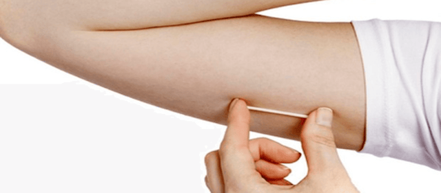 Birth Control Implant - Nurx™