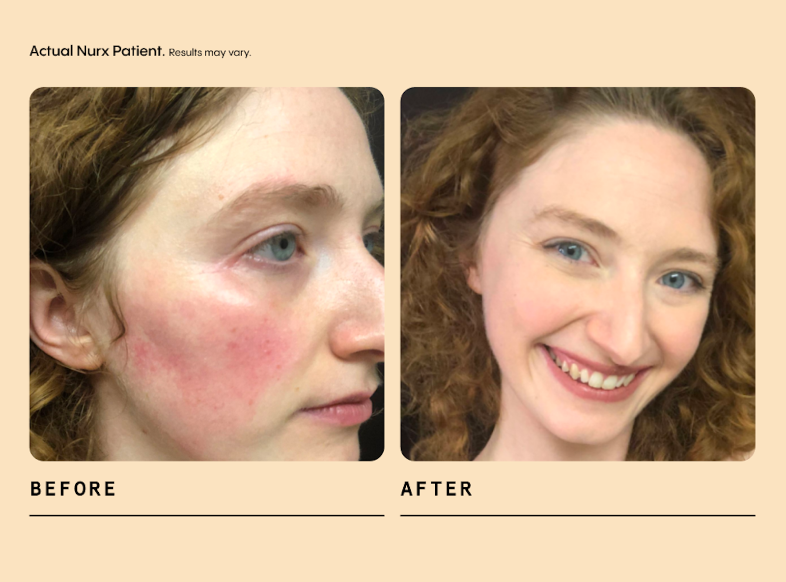 Rosacea Treatment - Nurx™