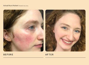 Rosacea Treatment - Nurx™