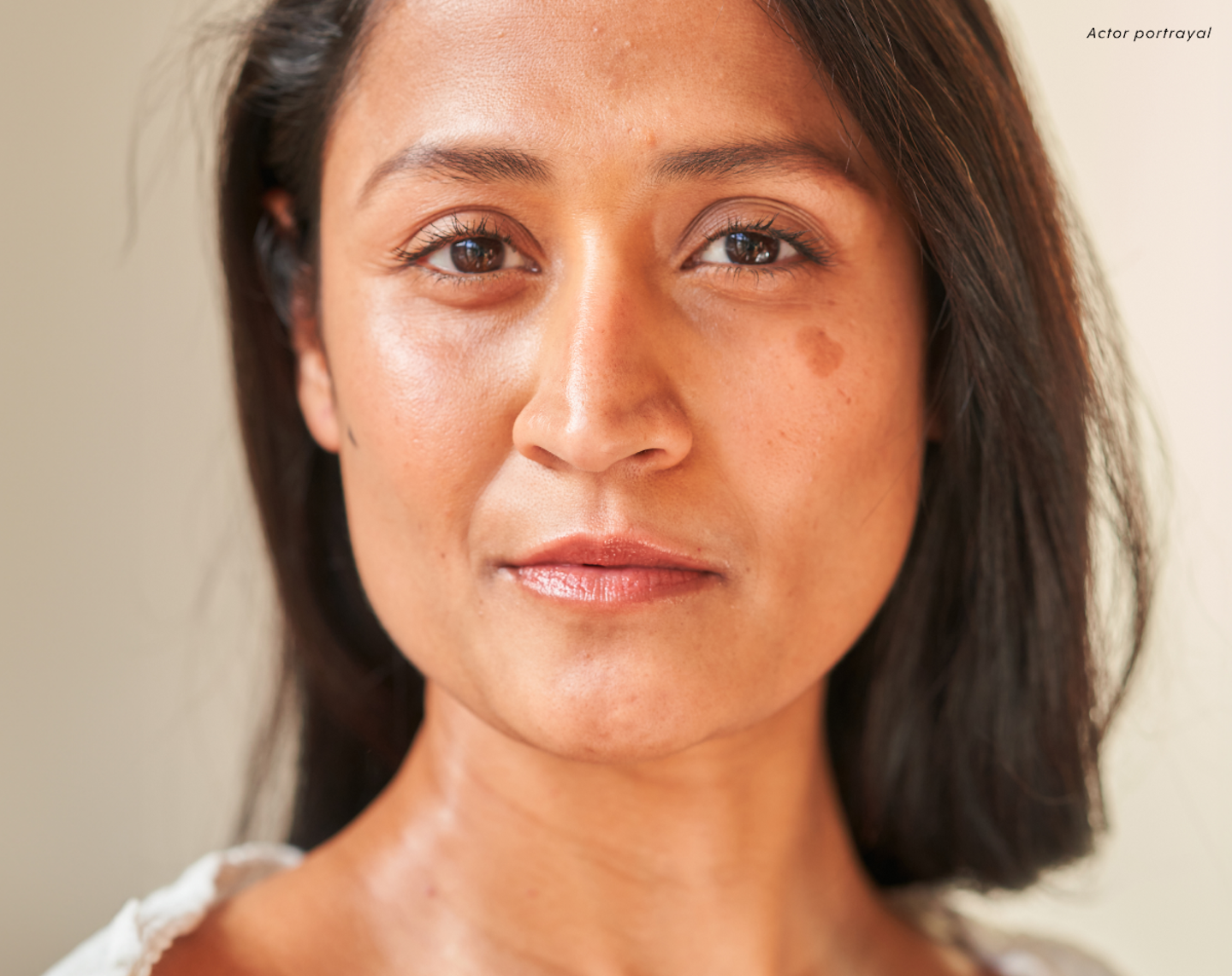 Online Melasma Treatment with Free Shipping - Nurx™